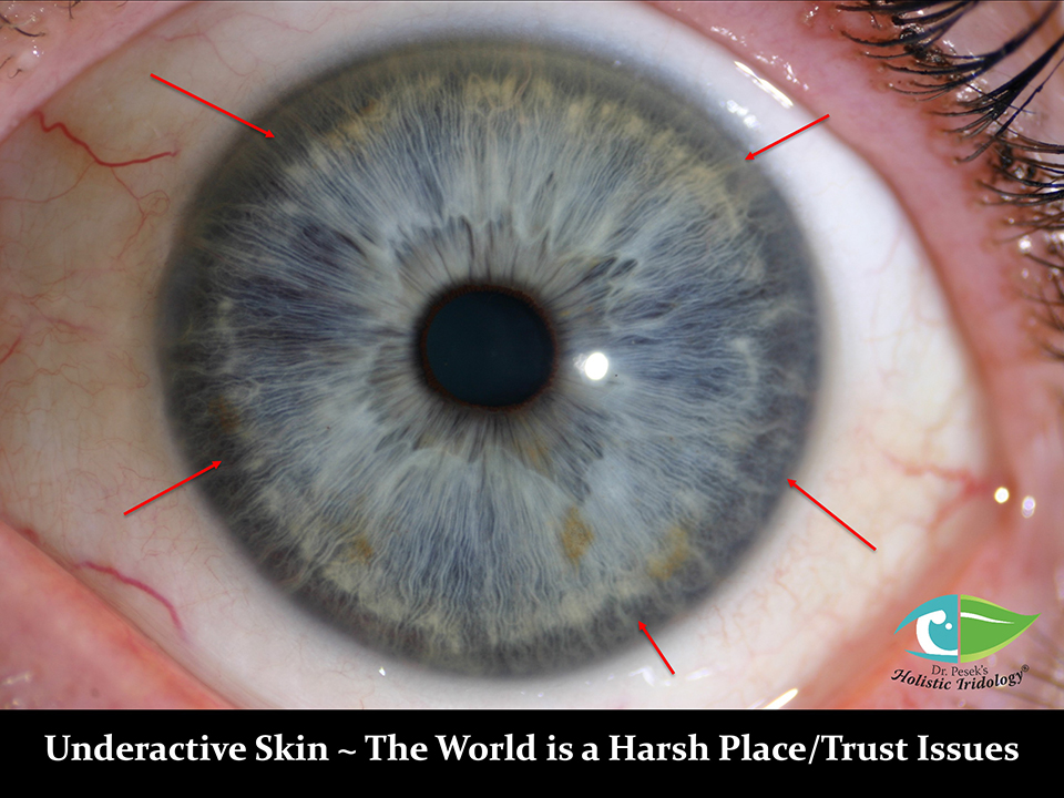 Iris Photos with Interpretation – Dr. Pesek's Holistic Iridology