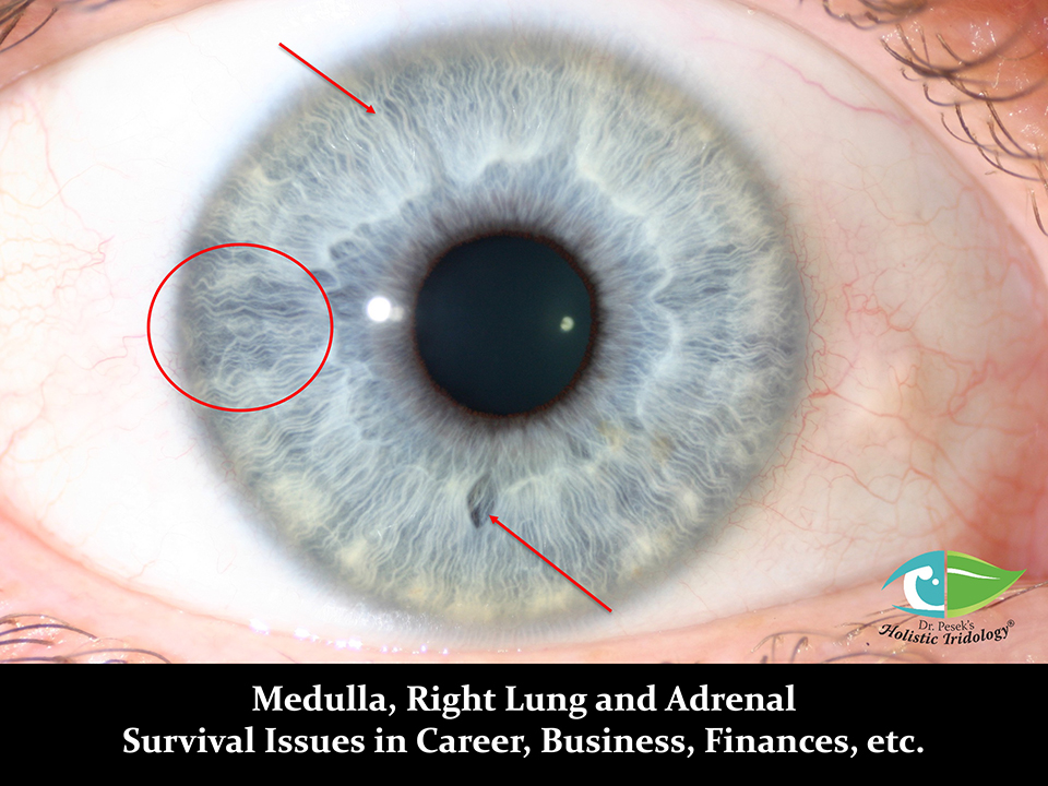Iris Photos with Interpretation – Dr. Pesek's Holistic Iridology