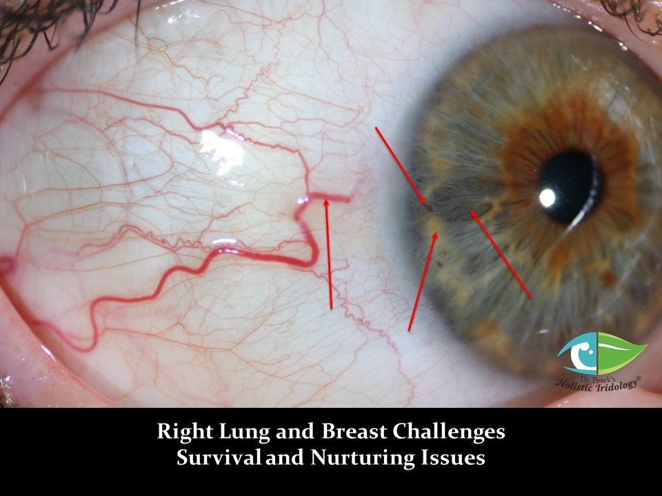 Iris Photos with Interpretation – Dr. Pesek's Holistic Iridology