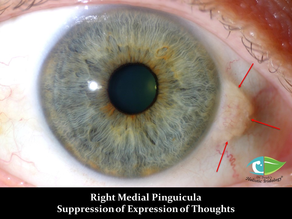 Iris Photos with Interpretation – Dr. Pesek's Holistic Iridology