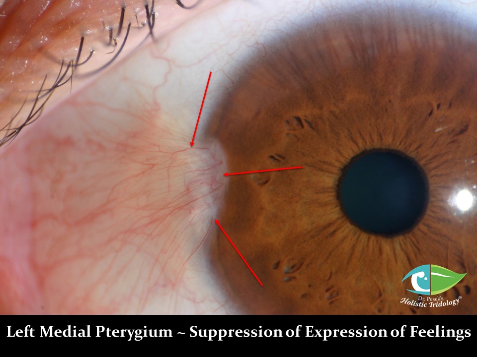Iris Photos with Interpretation – Dr. Pesek's Holistic Iridology